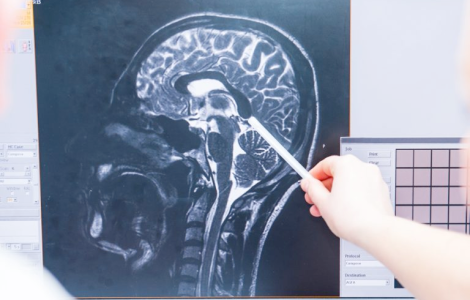 Stroke - NeuroTrauma Sciences